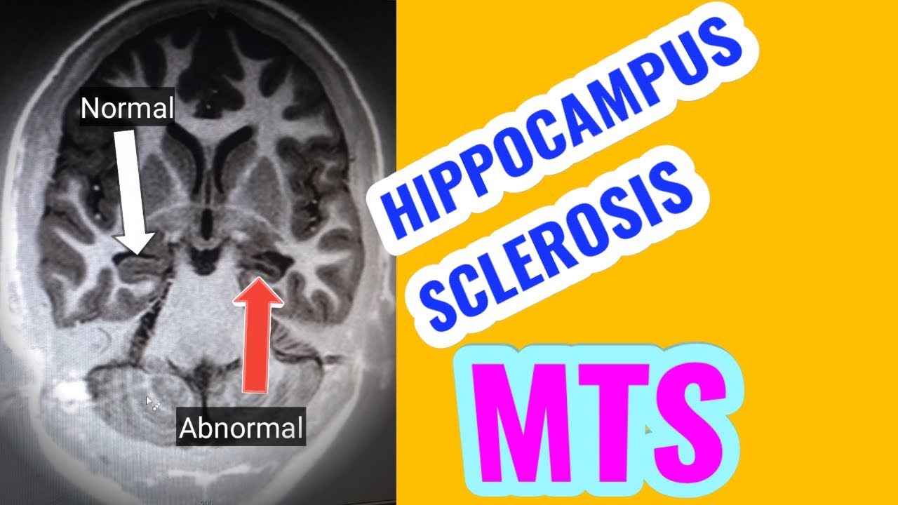 Mesial temporal sclerosis MRI STUDY - YouTube