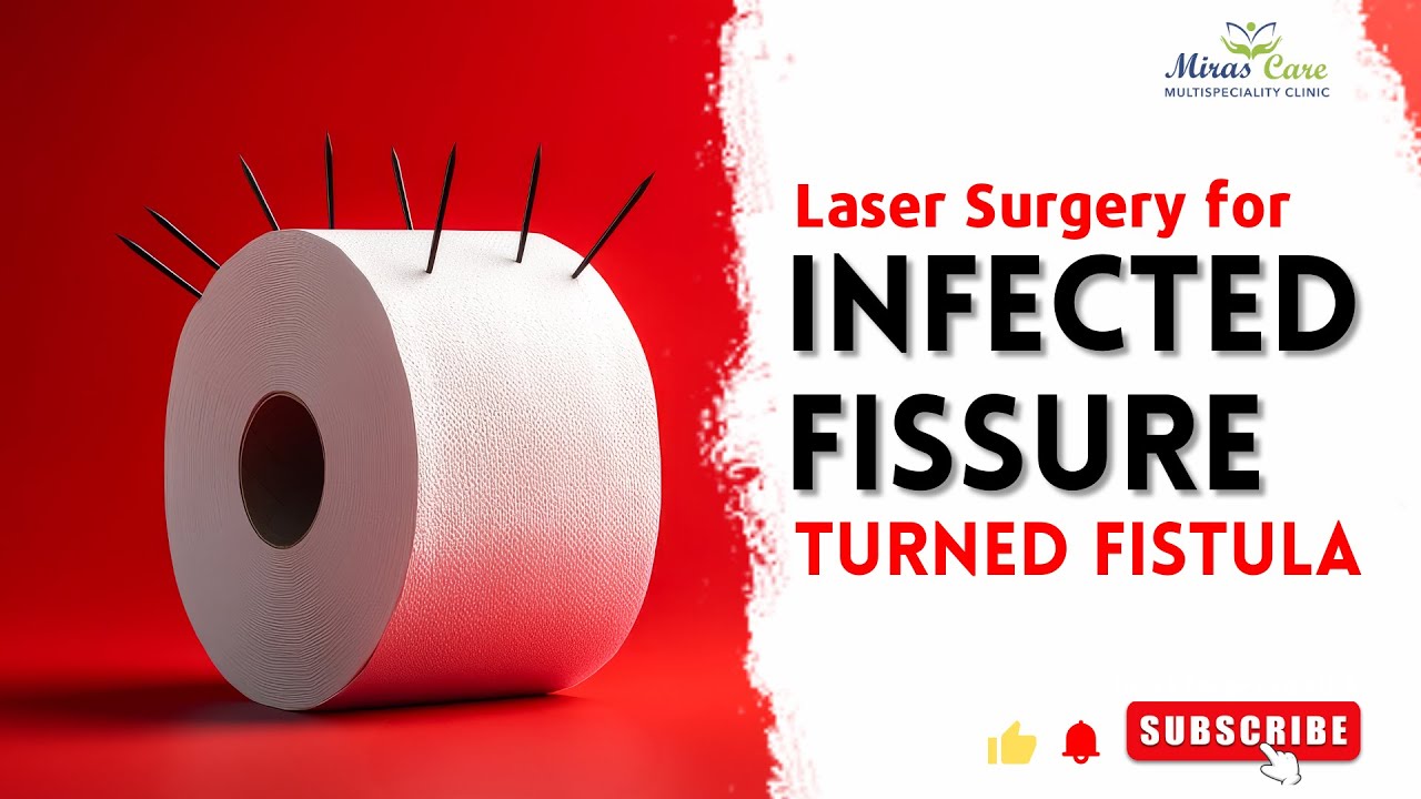 Laser treatment of Infected Anal Fissure which got converted into an ...