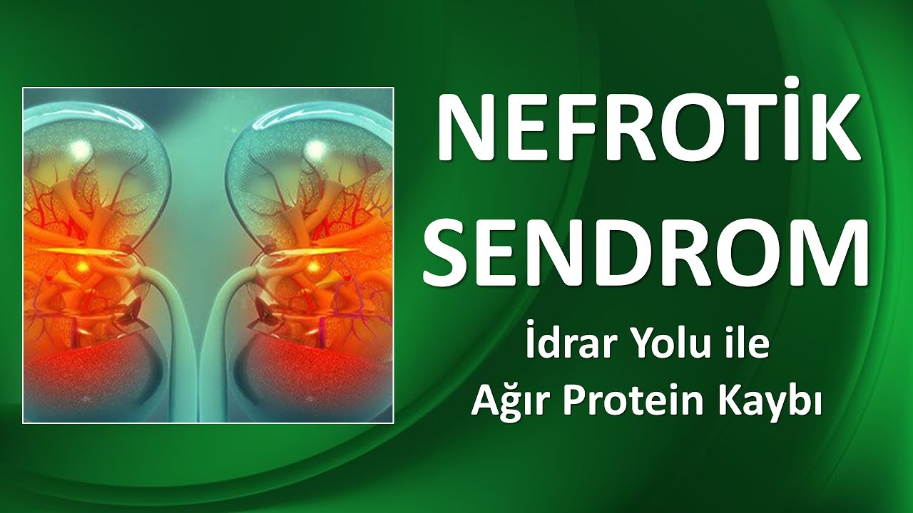NEFROTİK SENDROM NEDİR? İdrar Yolu ile Ağır Protein Kaybı - YouTube
