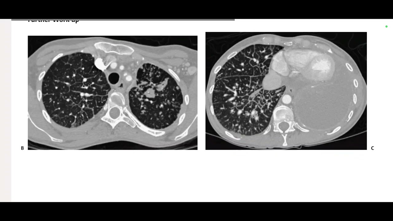 THORACIC IMAGING RAD CASES THIEME FRCR(2) - YouTube