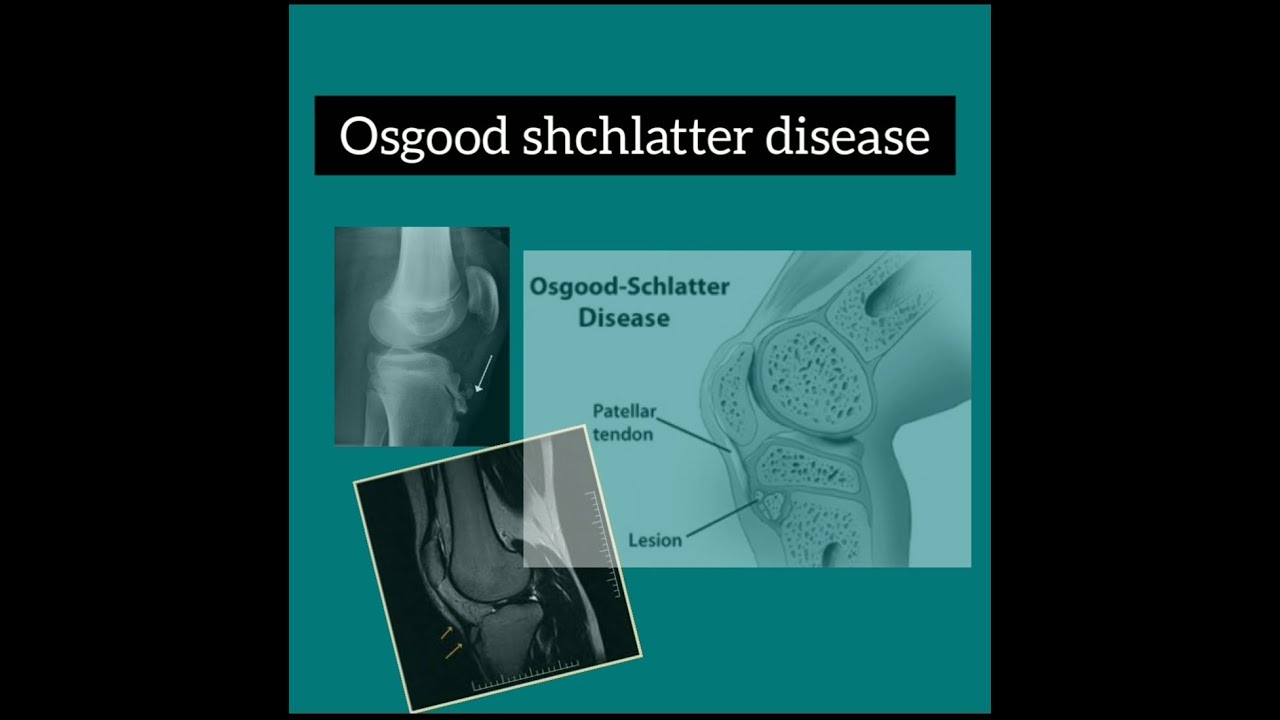 Osgood Schlatter Disease Mri