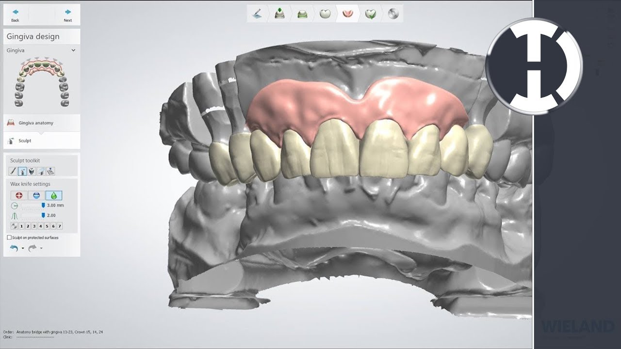 3Shape Study Club - Design Challenge #1 - DentalTechTips - YouTube