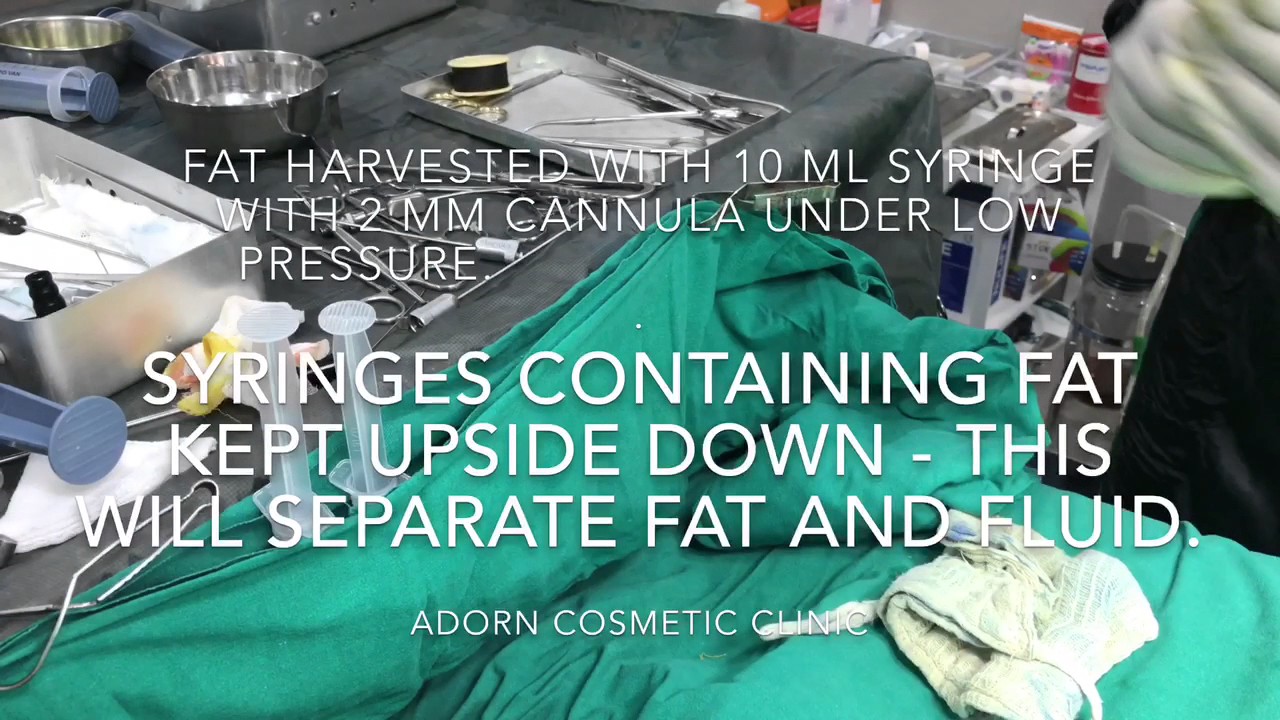 Micro Fat Injection- Harvesting Separating & Preparing for injection ...