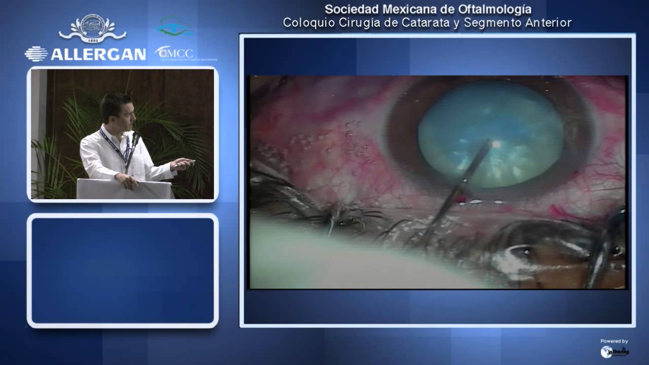 Faco en catarata intumescente - Dr. Erick Mendoza Schuster Ortiz ...