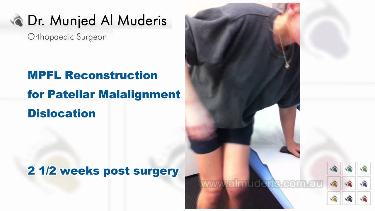 MPFL Reconstruction for Patellar Malalignment Dislocation - 2 1/2 weeks post surgery - YouTube