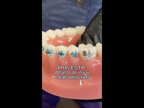 Can Braces Come Off Easily