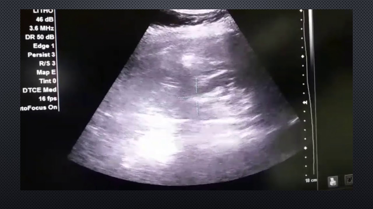 USG Guided ESWL for lower calyceal calculi - YouTube