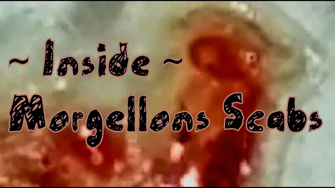 Inside Morgellons Scabs, Morgs Exhibit Complex Behaviors & Incomplete ...