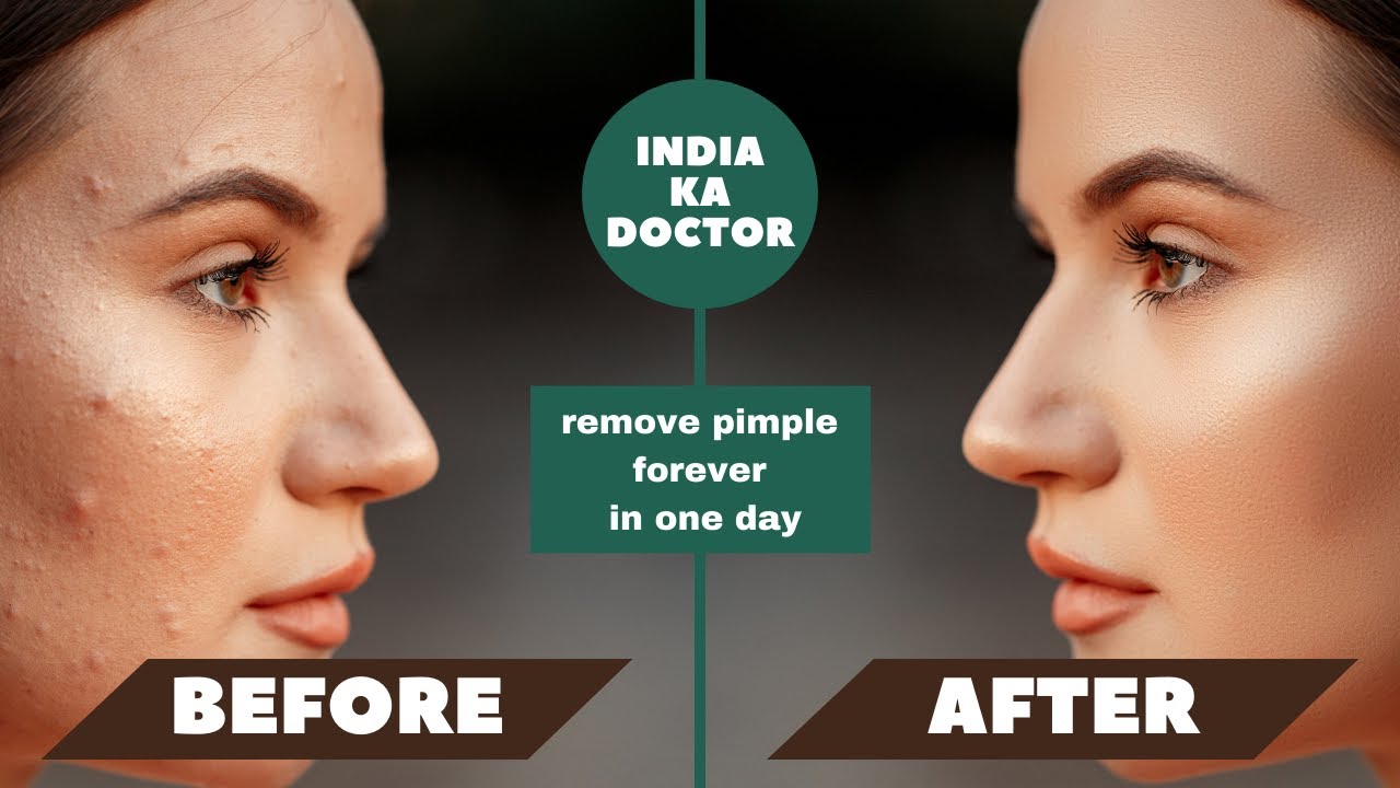 Remove Pimples Forever In 1 Day | Best Acne Treatment | Home Remedy For ...