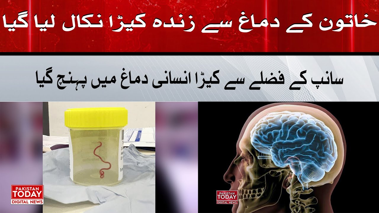 A live worm was removed from the woman's brain, the worm reached the ...
