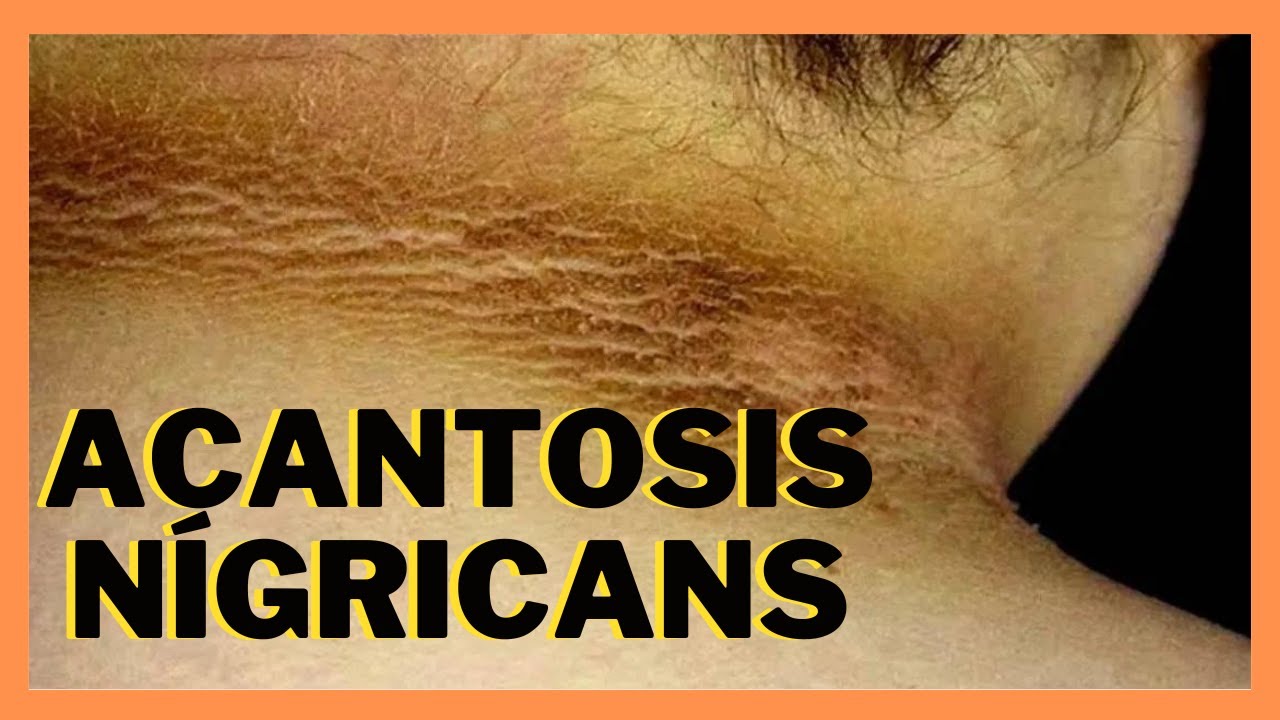¿Manchas oscuras en cuello, axilas o ingle? Tu cuerpo quiere decirte ...
