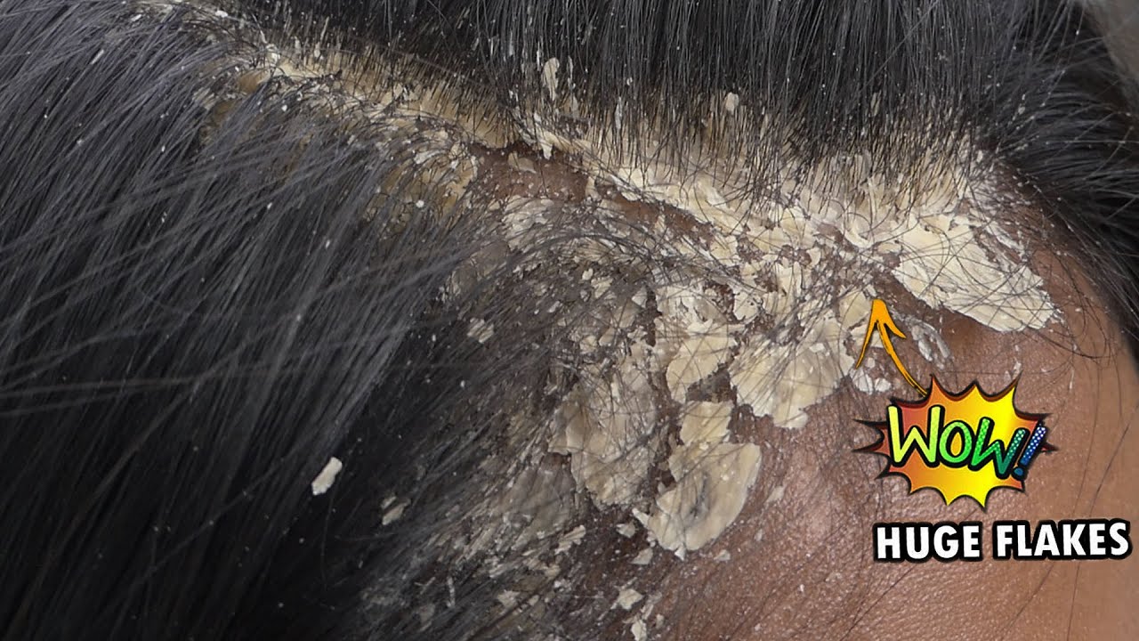 DRY SCALP !! Big Flakes Dandruff Scratching Satisfying Video #991 - YouTube