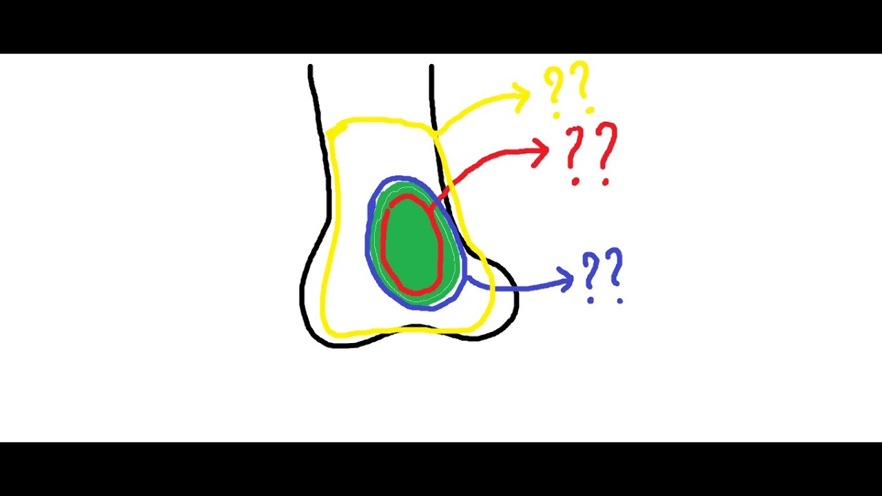 Types of Excision for Biopsy in case of Bone Tumour - YouTube