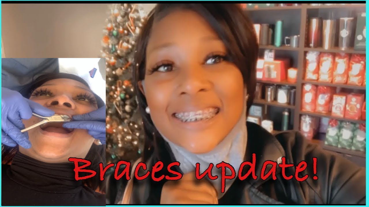 4 Months Braces Update! *Vlog* - YouTube