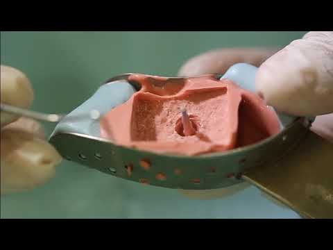 POST PREPARATION - INDIRECT TECHNIQUE - YouTube