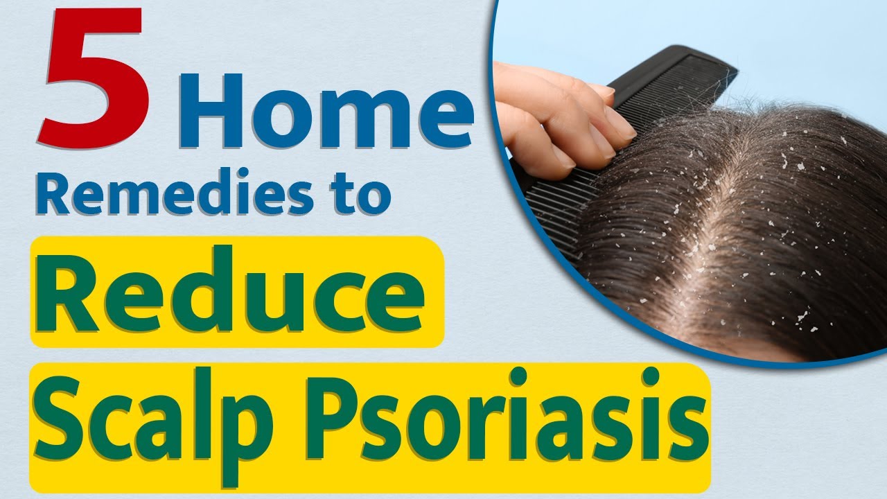 5 Best Home Remedies To Reduce Scalp Psoriasis Bharat Homeopathy