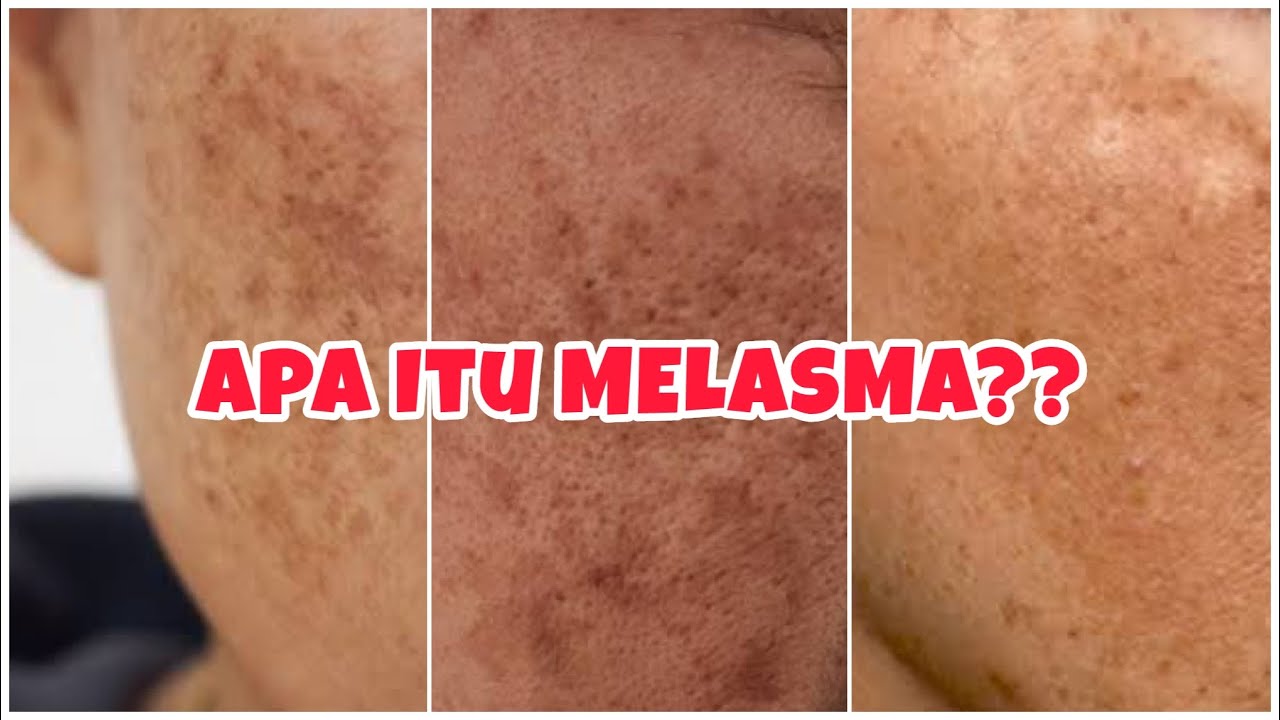 Mengenal Melasma Dan Cara Mengatasinya - YouTube