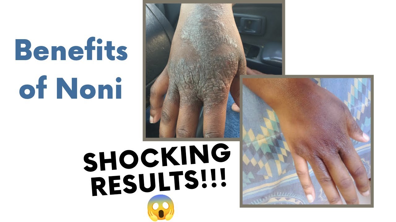 Unbelievable Noni Results/You Must Watch This To Believe - YouTube