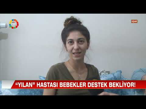 YILAN HASTASI BEBEKLER DESTEK BEKLİYOR