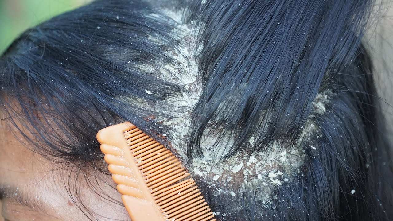 Deep Scalp Scratch Reveal — Flakes Burst Out Instantly #275 - YouTube