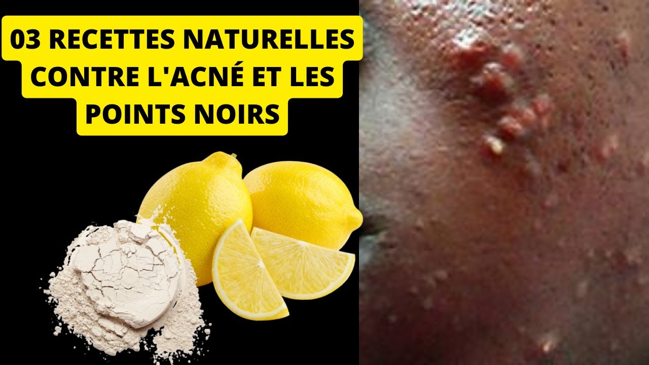 03 recettes naturelles efficaces contre les boutons - YouTube