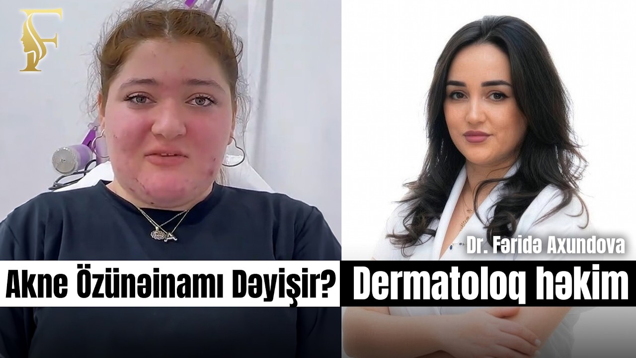 “Sızanaqdır, Keçər” Demək Bu Qədər Asan Deyil #dermatoloq - YouTube