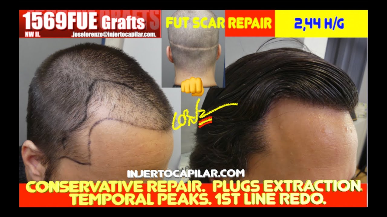 1569FUE Grafts.Repair NW II.Scar. Plugs extraction. Temporal peaks. 1st ...