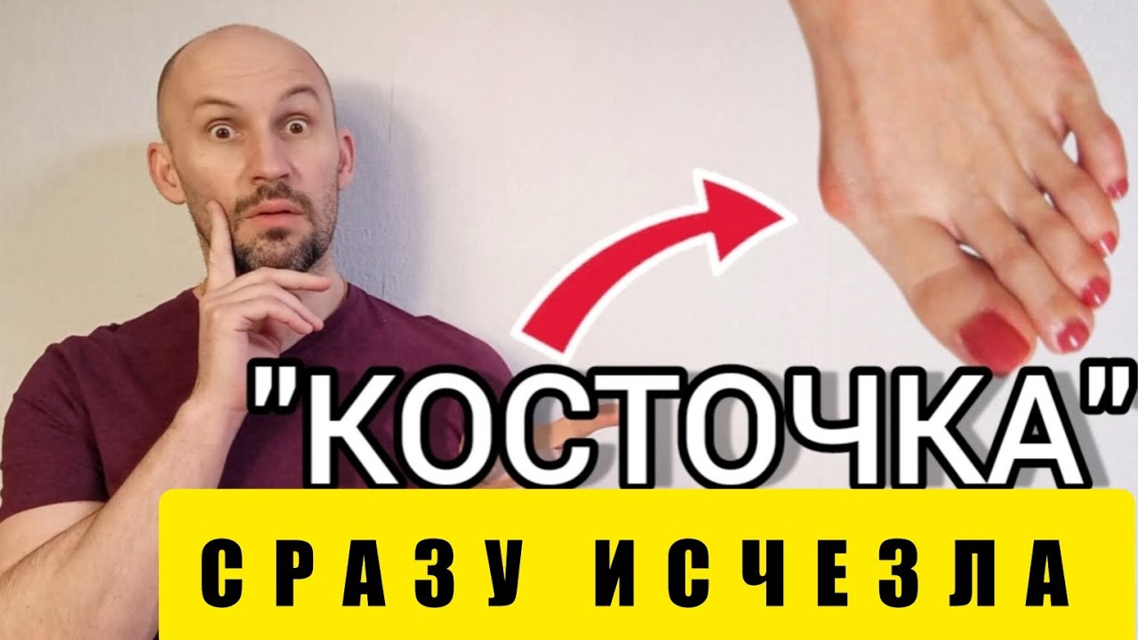 Косточка на большом пальце ноги ушла НАВСЕГДА за 5 МИНУТ Youtube