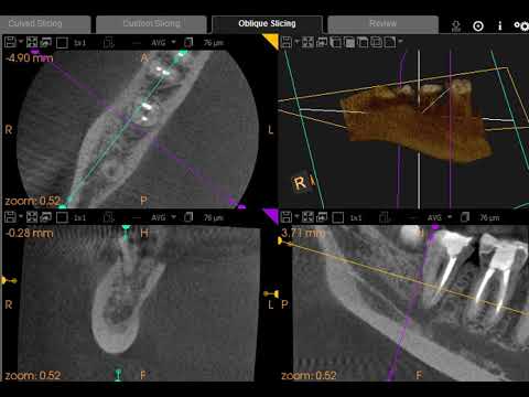 Proximity of IAN canal to the PA of mandibular second molar - YouTube