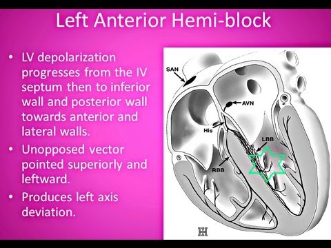 Conduction Abnormalities on EKG - Medical Presentation - YouTube