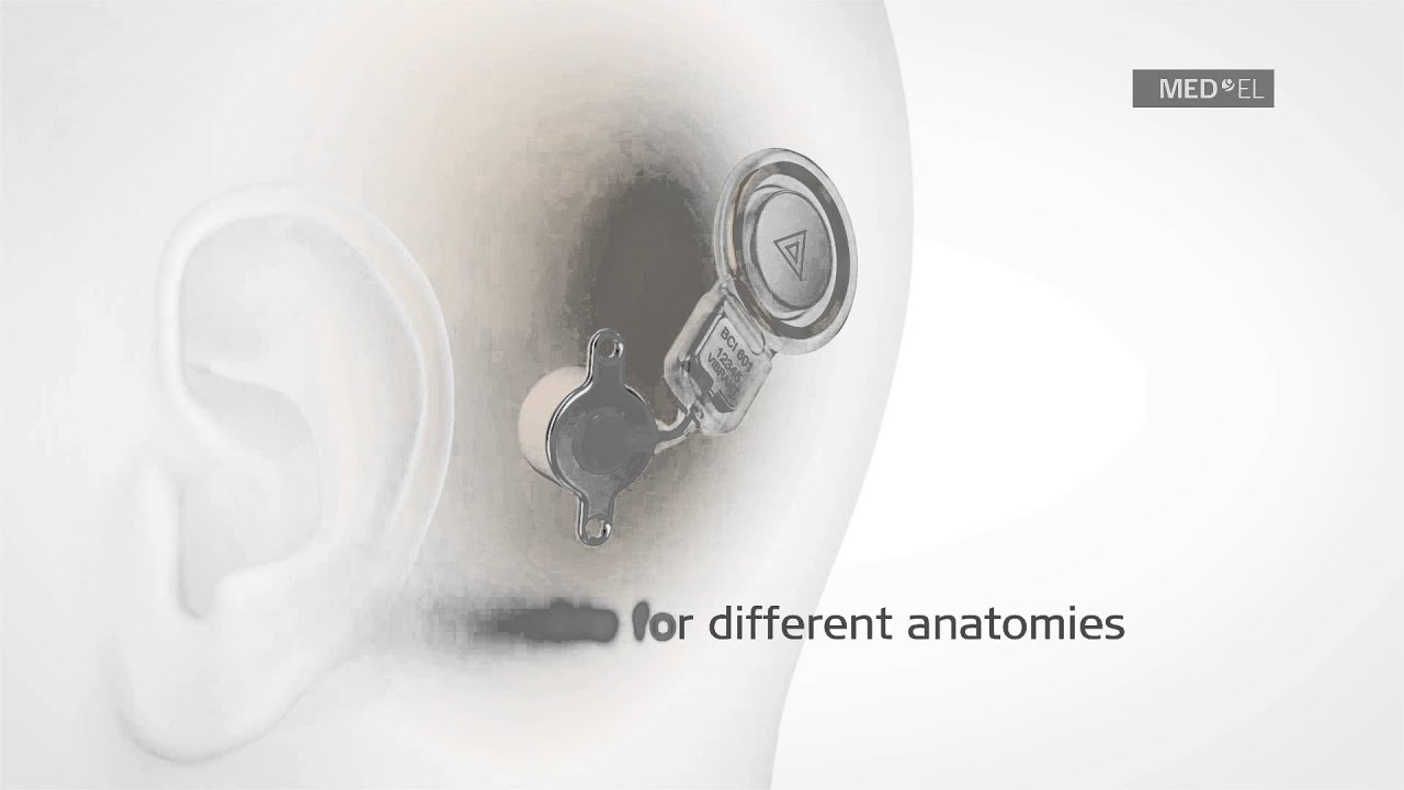 Key features of the BONEBRIDGE implant - YouTube