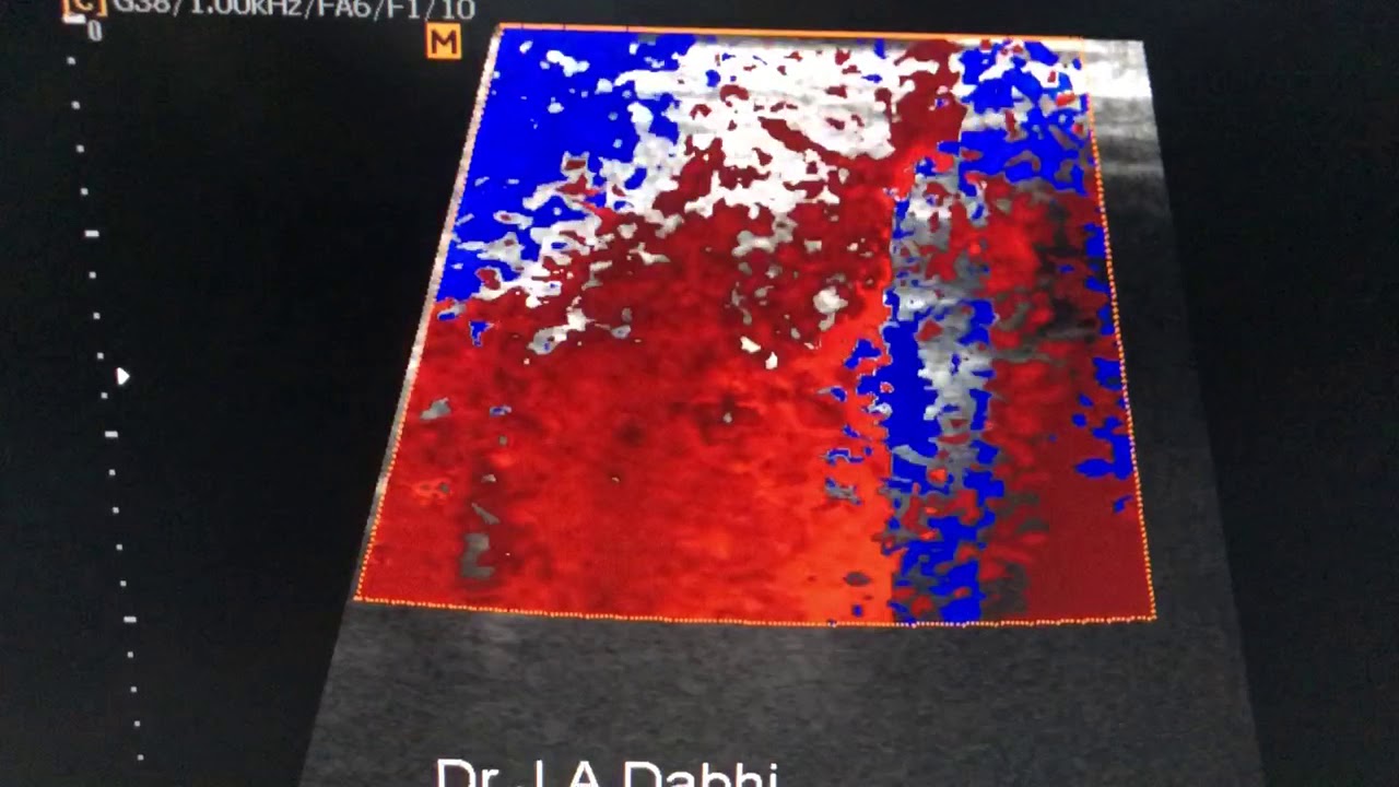 Inflammed parotid and submandibular glands - YouTube