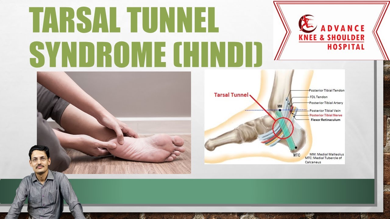 Tarsal Tunnel Syndrome Hindi Youtube