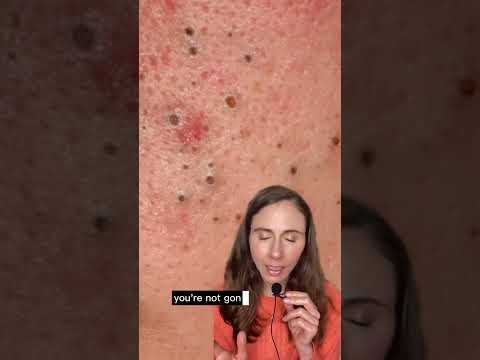 How to remove blackheads #dermatologist #blackheads #blackheadremoval