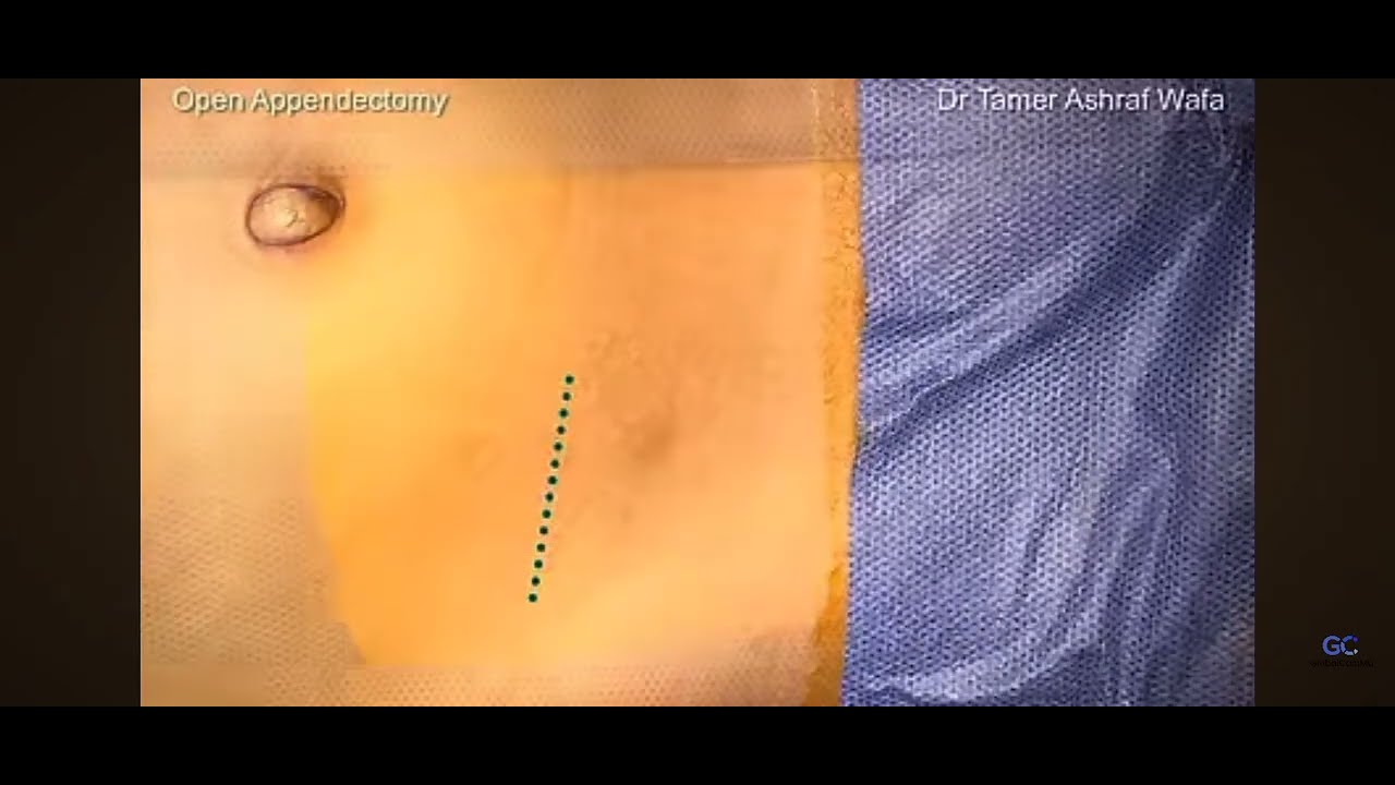 Surgical procedure Open appendectomy - YouTube