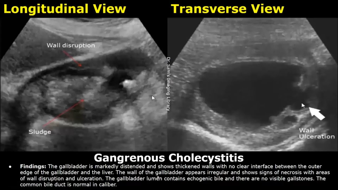 Normal Common Bile Duct Ultrasound Ultrasound / Classification Of