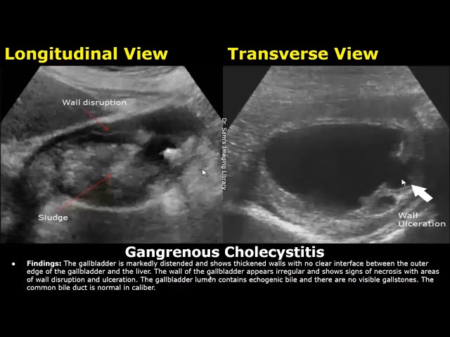 Ultrasound Of Abdomen Results Pediatric Abdominal Ultrasound