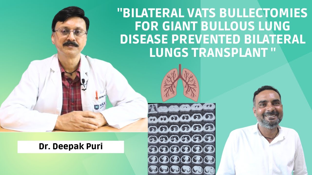 Bilateral VATS Bullectomies for Giant Bullous Lung Disease prevented ...