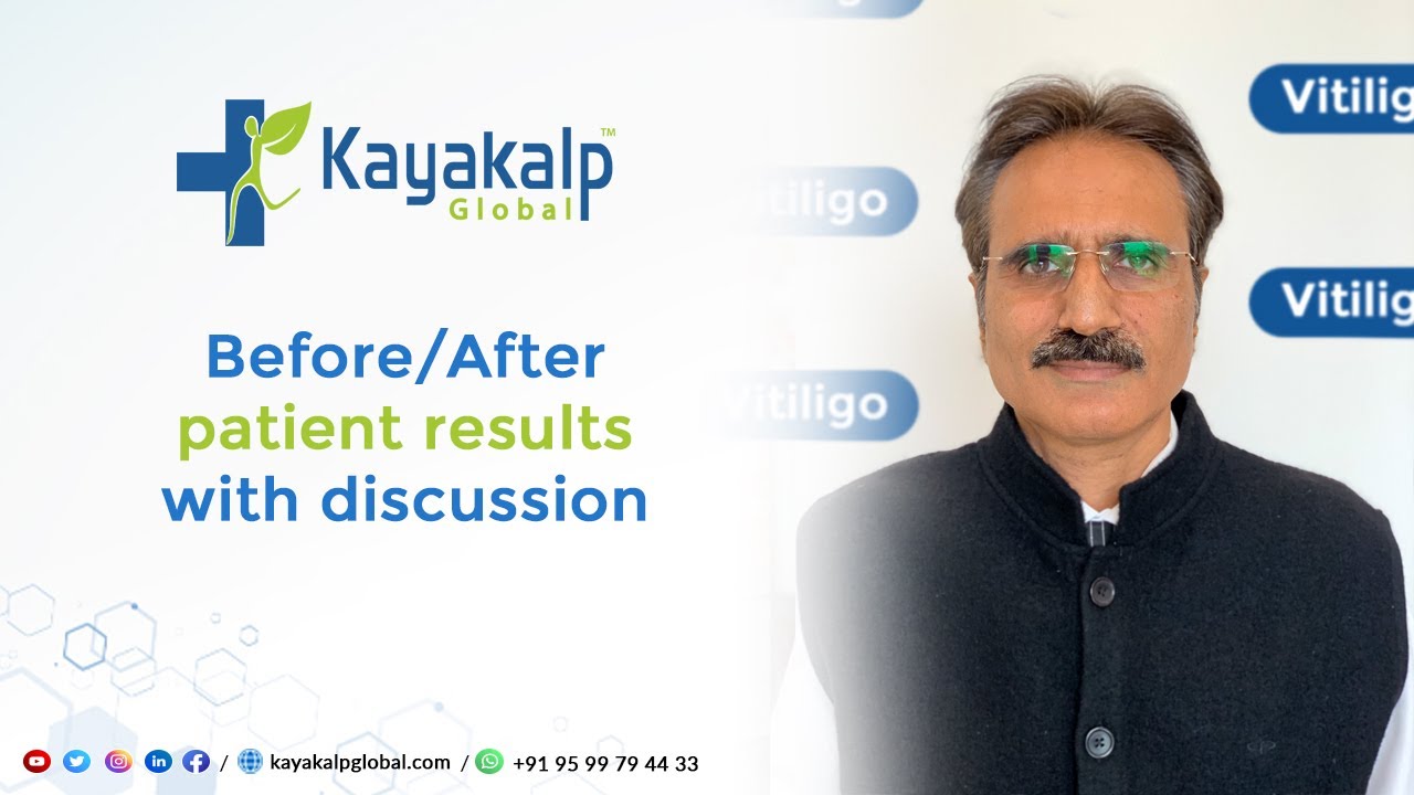 Safed Daag ka ilaaj Recovery Before & After | Patients' Results ...