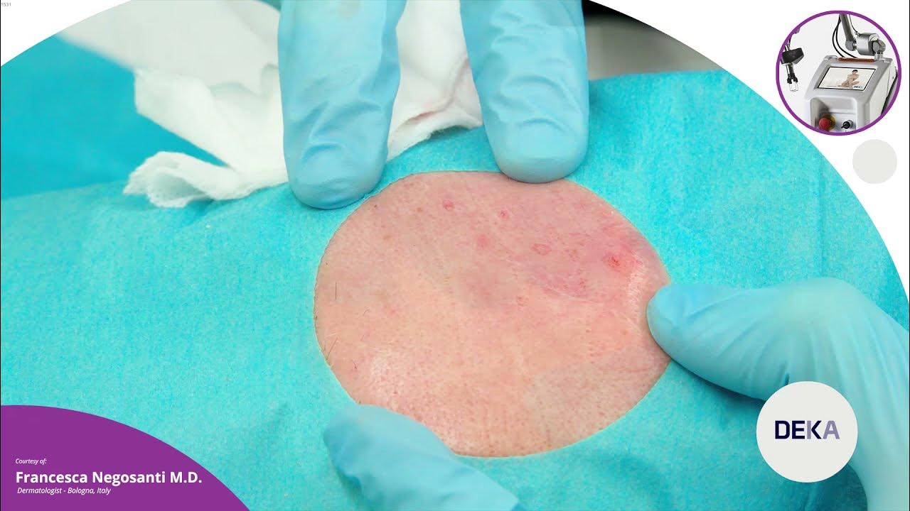 Training Deka Smartxide Punto Seborrheic Keratosis Co2 Laser