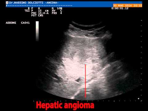 Angioma epatico lobo sinistro - YouTube