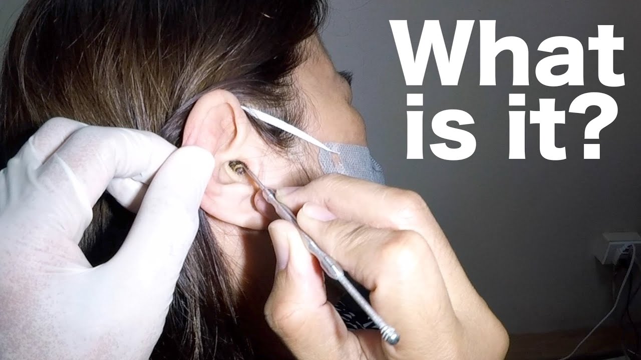 Something Dry Stuck in Woman's Ear | Is it Earwax or Not? - YouTube