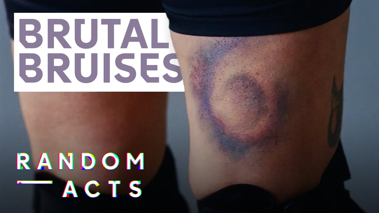 Brutal Bruises from Roller Derby | Derby Kiss by Fanny Hoetzeneder ...