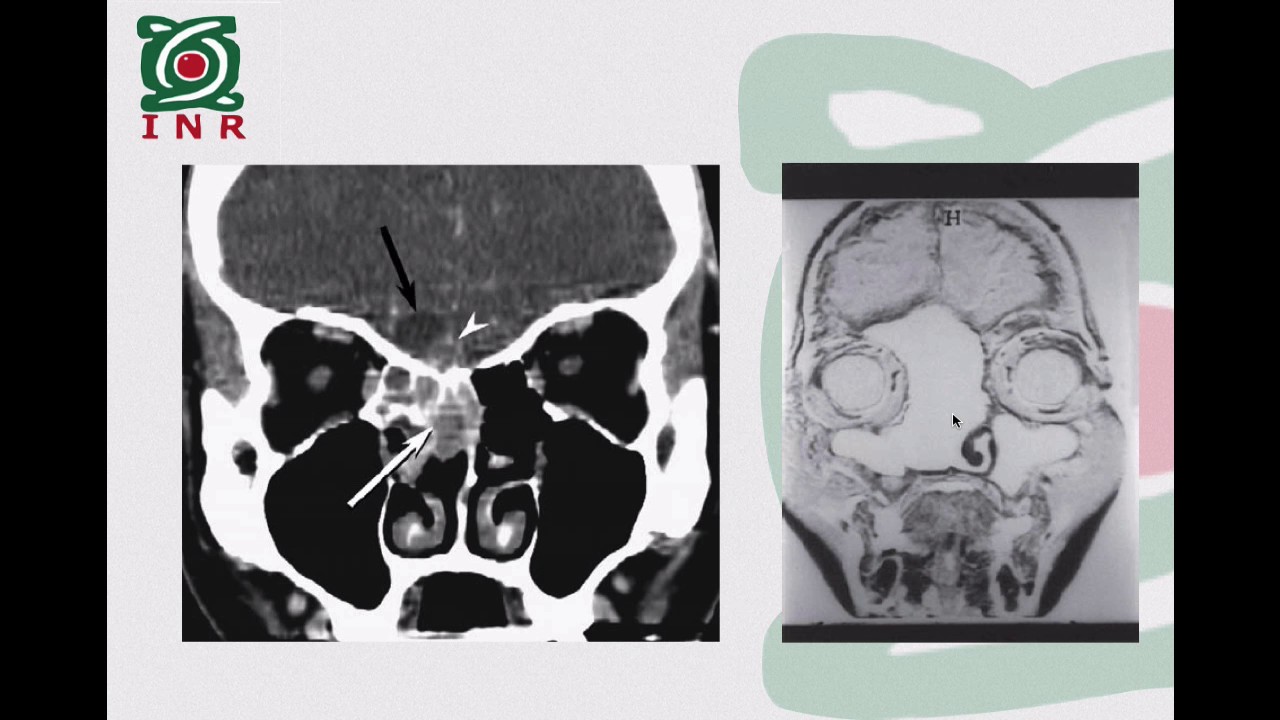Tumores de SPN 3 - YouTube