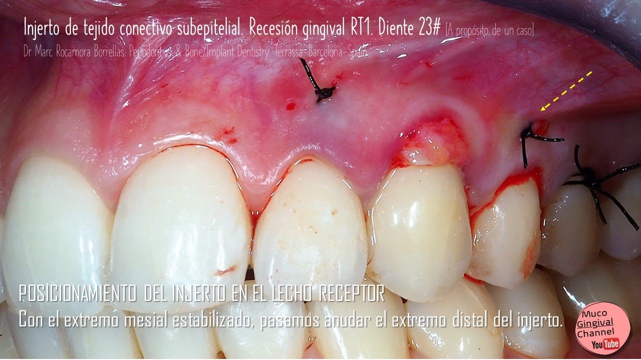RECESION GINGIVAL. TRATAMIENTO QUIRÚRGICO MEDIANTE INJERTO CONECTIVO ...