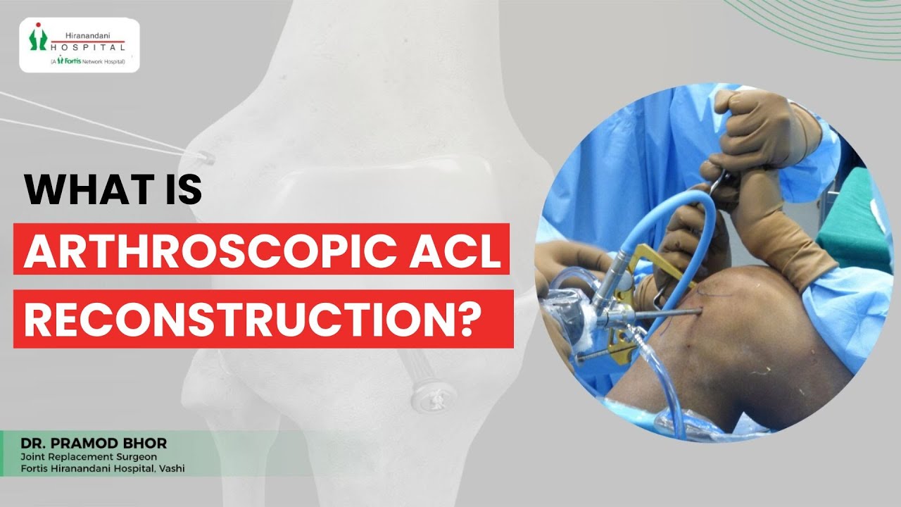 What Is Arthroscopic ACL Reconstruction? | Knee Arthroscopic Surgery | Dr. Pramod Bhor | VAS ...