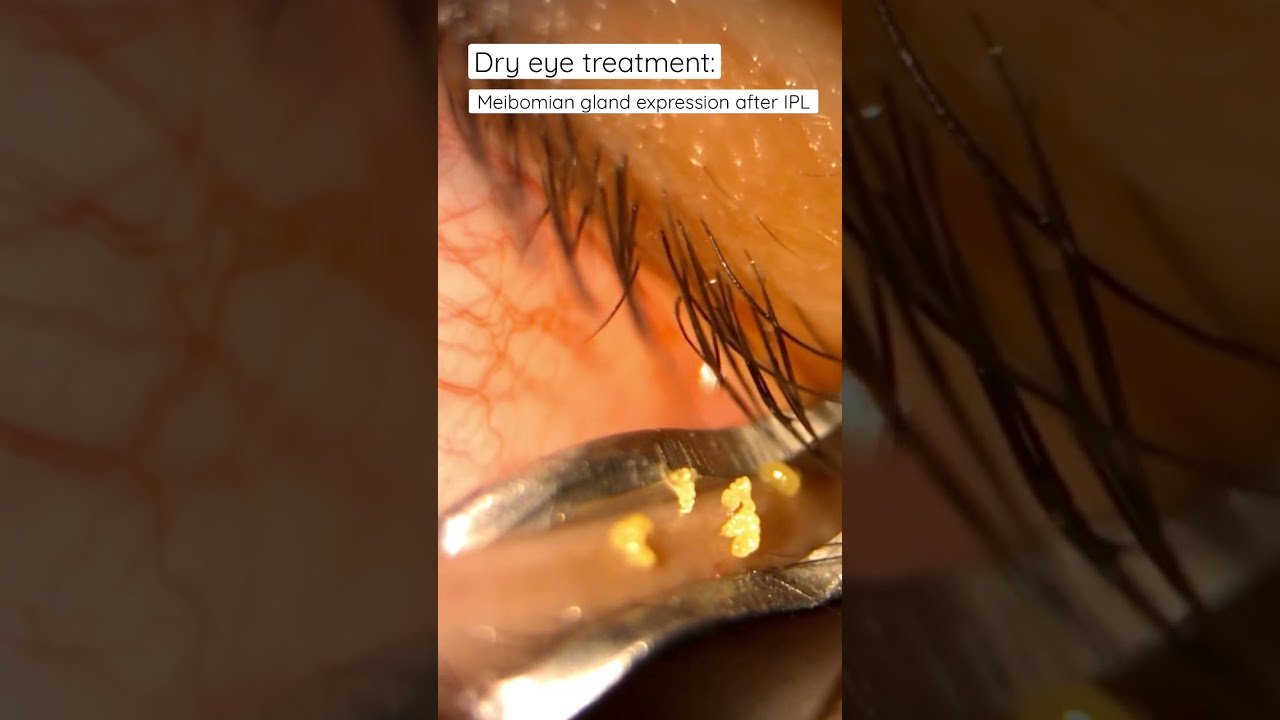 Meibomian gland expression after IPL - YouTube