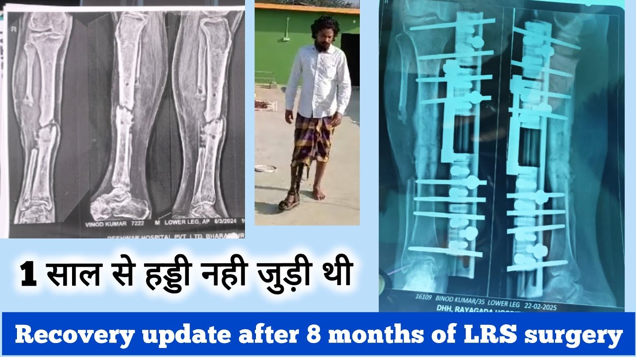 Non-union tibia fibula bone fracture treatment with LRS fixation # ...