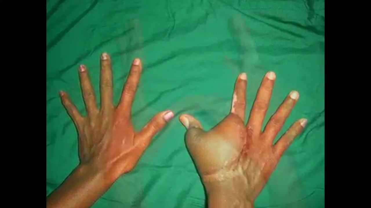 Post Burn Hand Contracture ( Olympia Hospital, Trichy, India) - YouTube