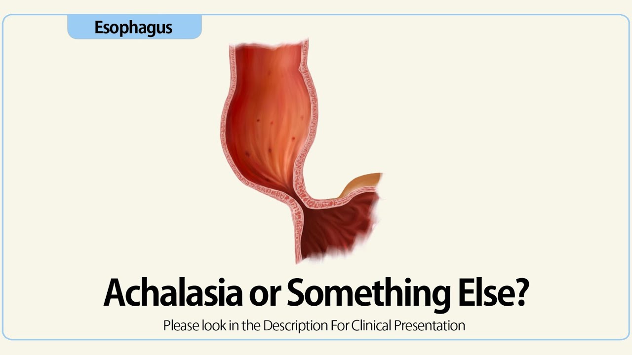 Achalasia or something else? - YouTube